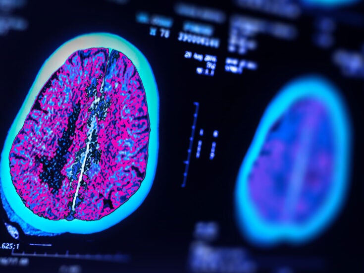 AI harnessed for traumatic brain injury prognosis - Verdict